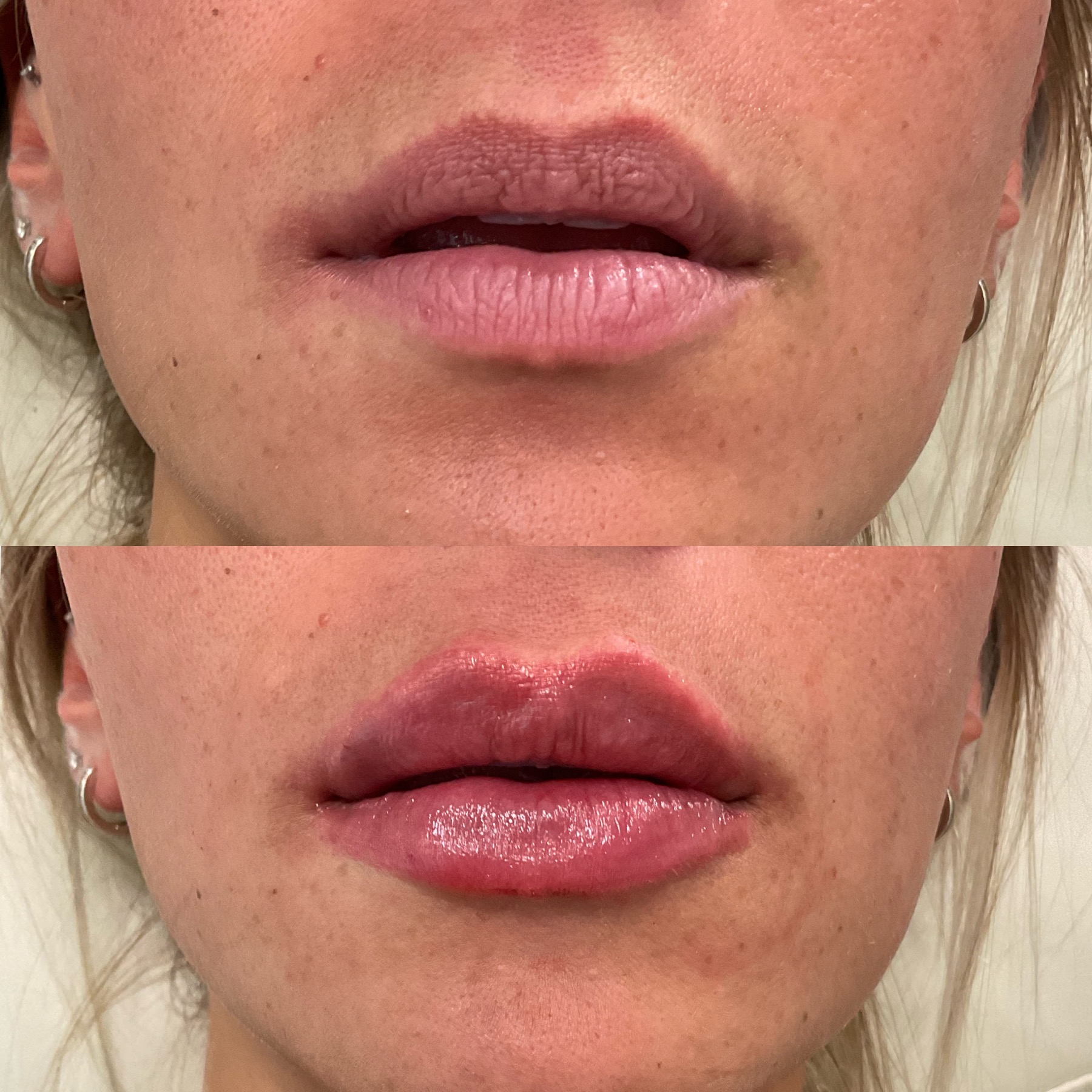 Lip Filler in Medina | Radiant Divine Medical Spa