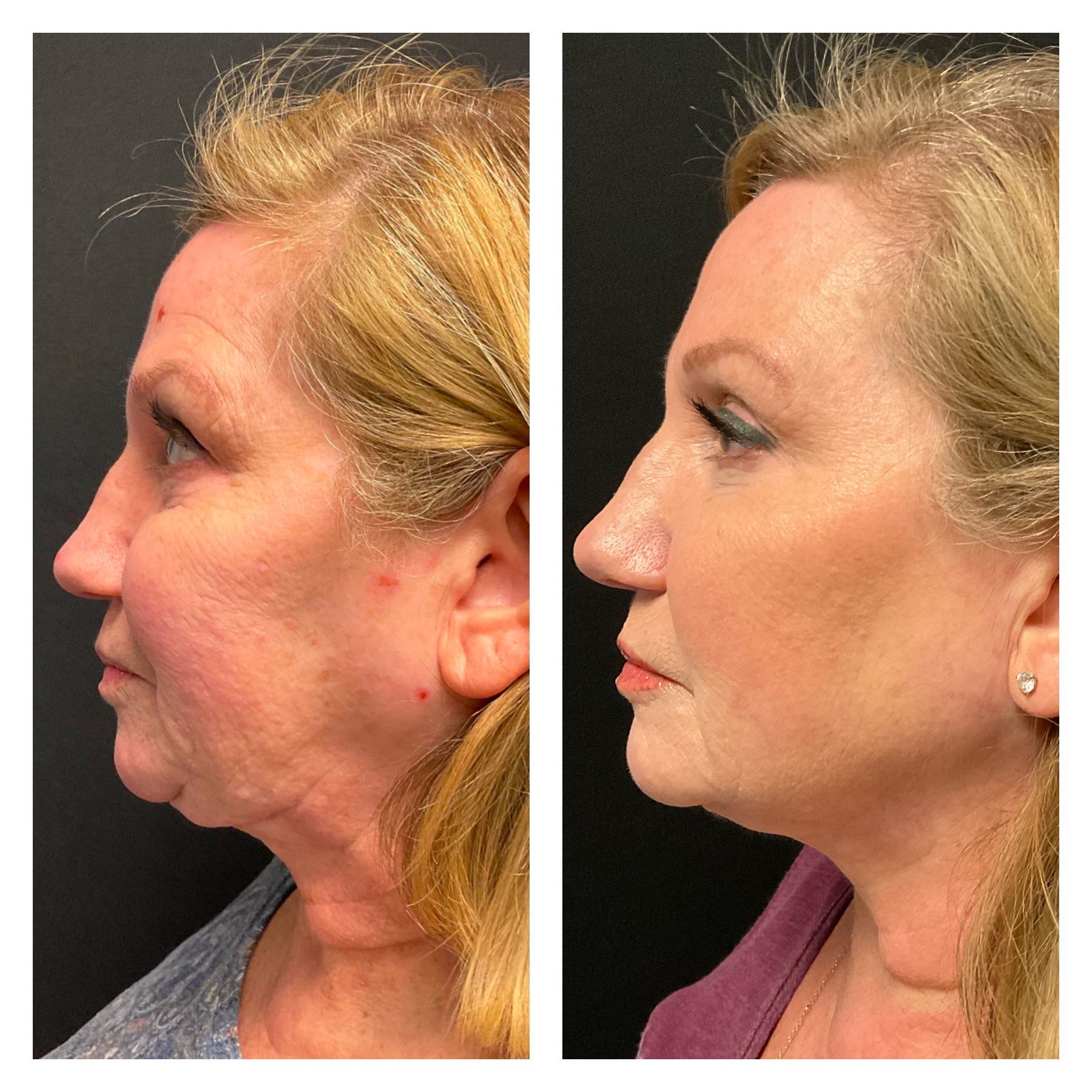 Skin Tightening Treatments in Chagrin Falls | Radiant Divine